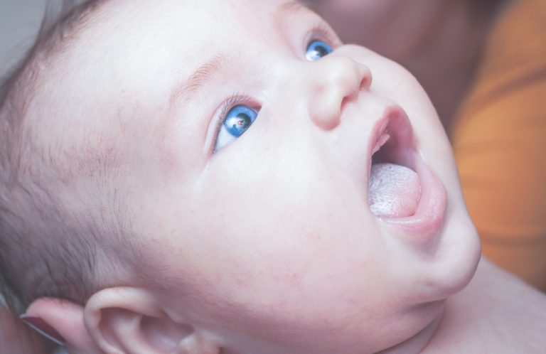 How to treat Thrush Naturally in Babies